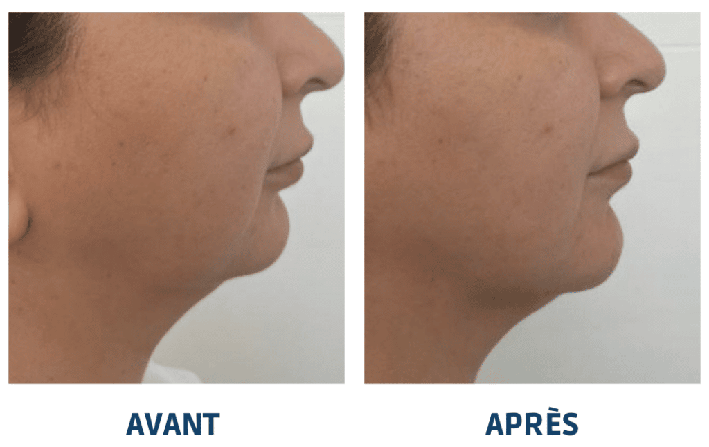 Médecine Esthétique - Centre Epilation Laser Elsa