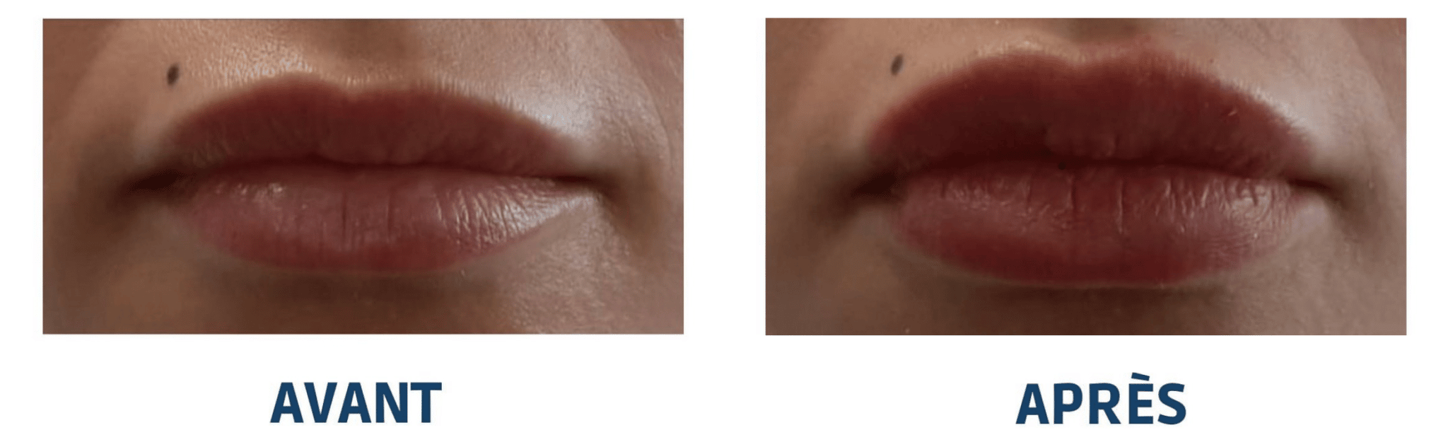 Médecine Esthétique - Centre Epilation Laser Elsa